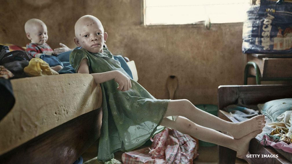 BBC - Living with albinism