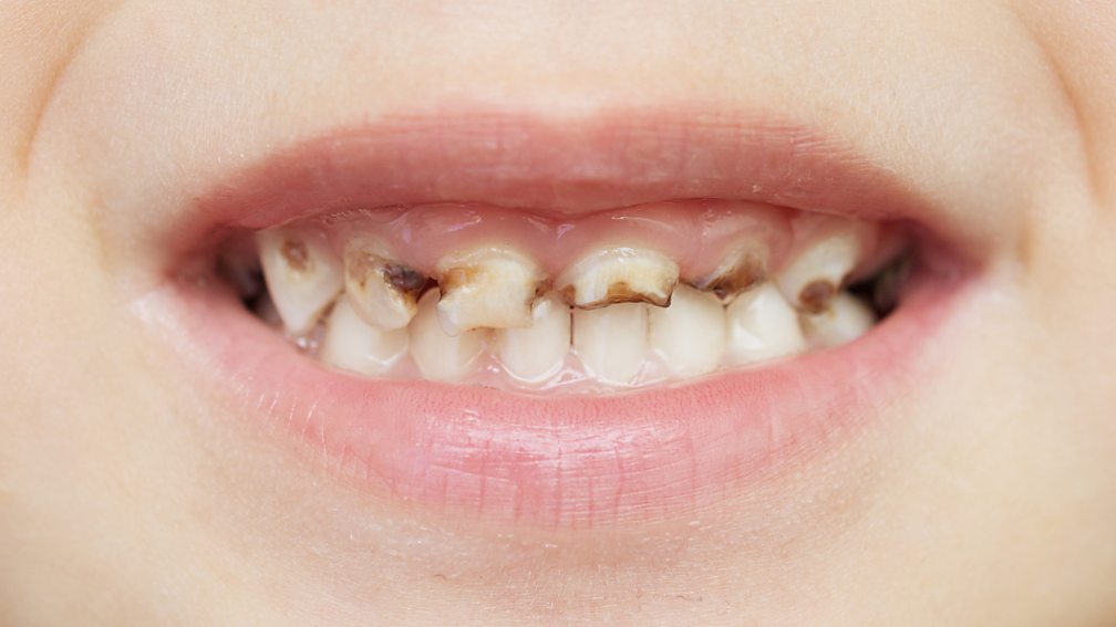 Dental caries - Priority health issues – CCEA - GCSE Home Economics ...