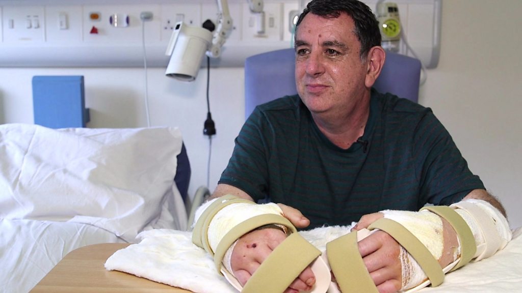Double hand transplant: UK's first operation 'tremendous' success - BBC ...