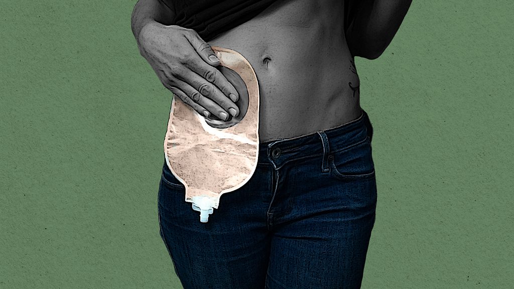 The Food Chain - How a stoma changed my life - BBC Sounds