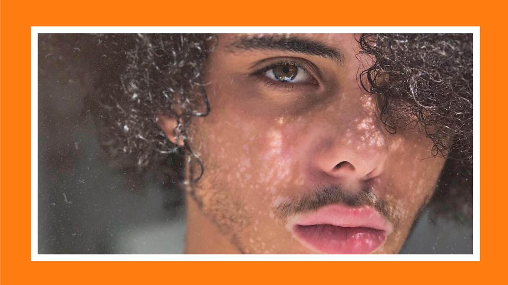 ‘If my vitiligo vanished, I’d be distraught’ - BBC Three