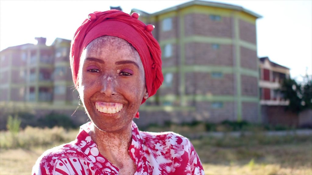 Scleroderma activist: 'I used to be scared looking in the mirror'