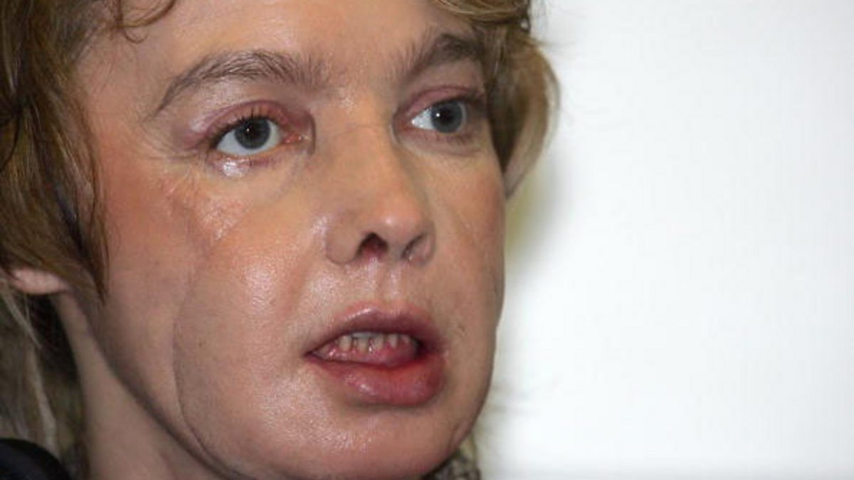 BBC World Service - Witness History, Isabelle Dinoire: The World's ...