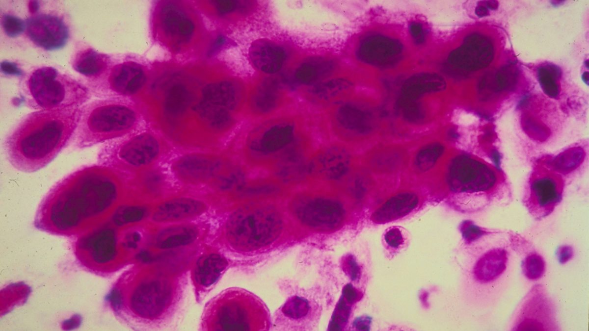 BBC World Service More Or Less Could Statistics Cure Cancer bbc-world-service-more-or-less-could-statistics-cure-cancer