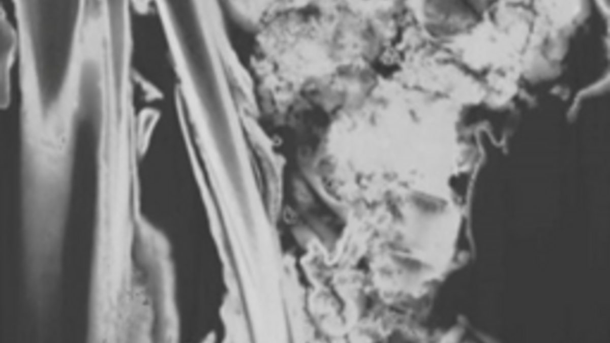 BBC Four - Cashel Man's X-ray - 4,000-Year-Old Cold Case: The Body in ...