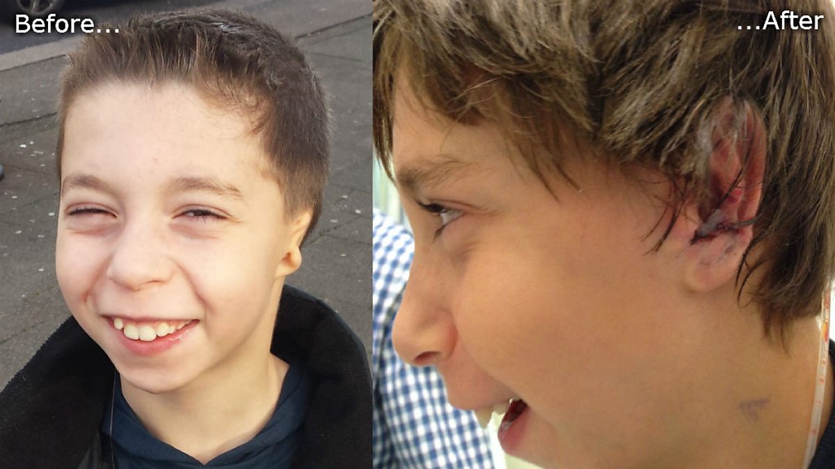 BBC Radio 5 Live - 5 Live In Short, Boy born without ears has pair ...