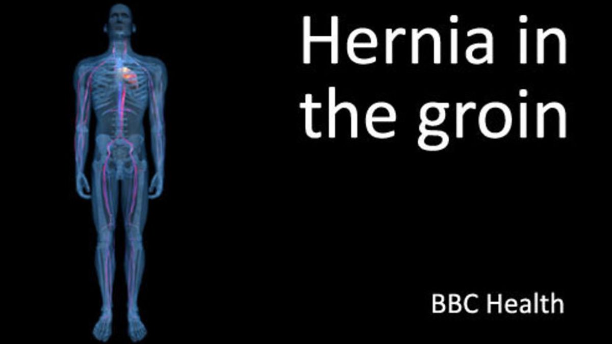 BBC - BBC Health, Surgical procedures: hernia in the groin