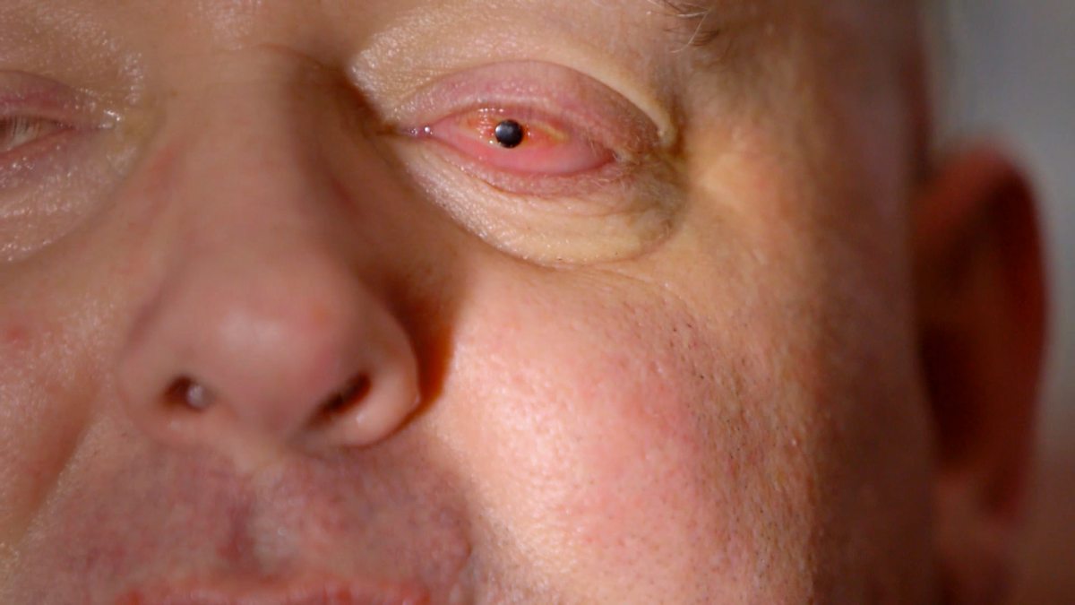 BBC Two - World's Weirdest Events, Episode 6, Tooth cures blindness