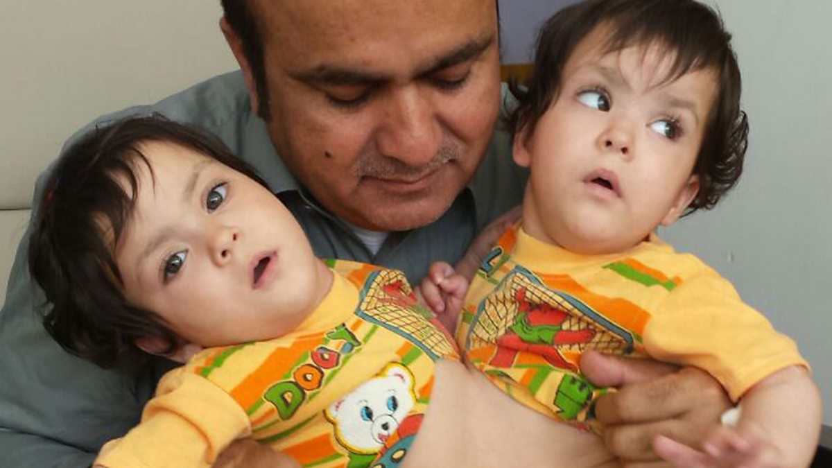 BBC World Service - Outlook, Saving my conjoined twins