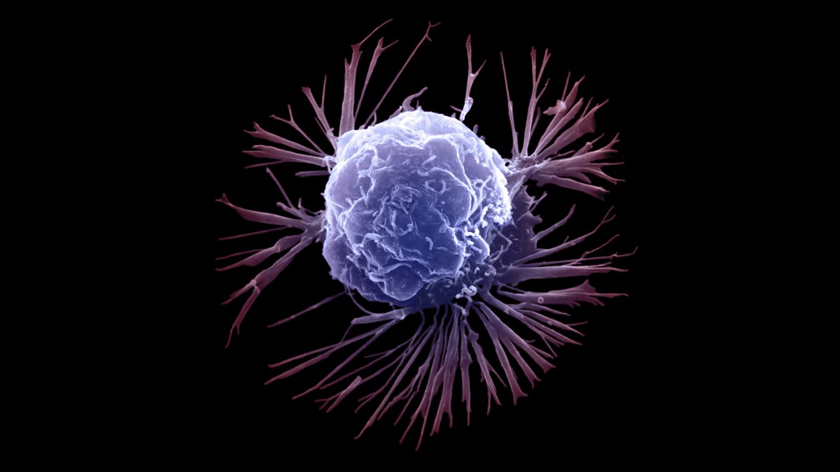 BBC - My Cancer Story