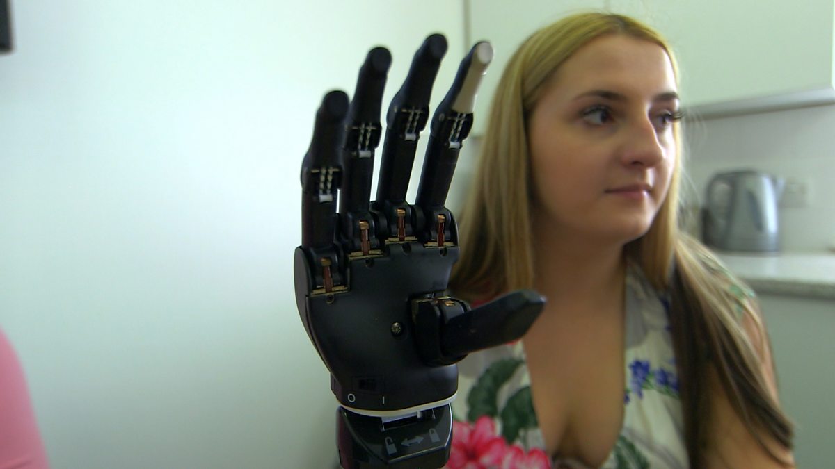 BBC News - Scotland, Bionic Hand