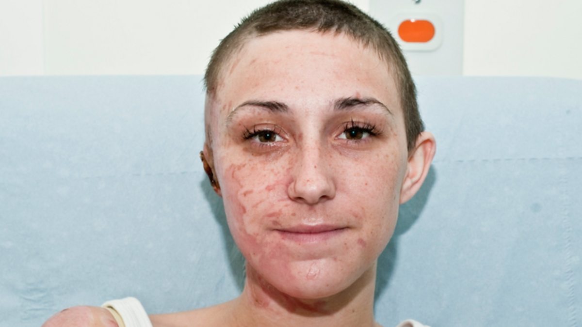 BBC News - Acid Attacks: A Journey To Recovery