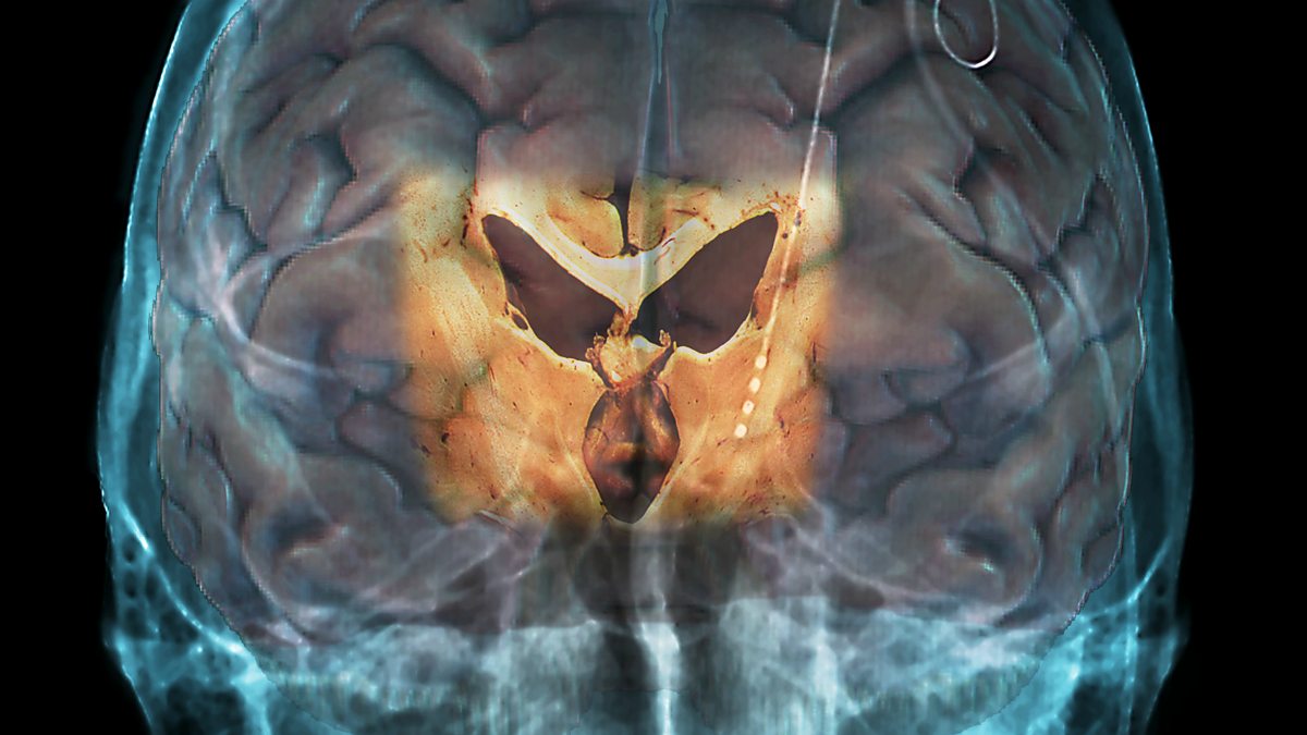 BBC World Service - Digital Planet, Brain implant regulation calls