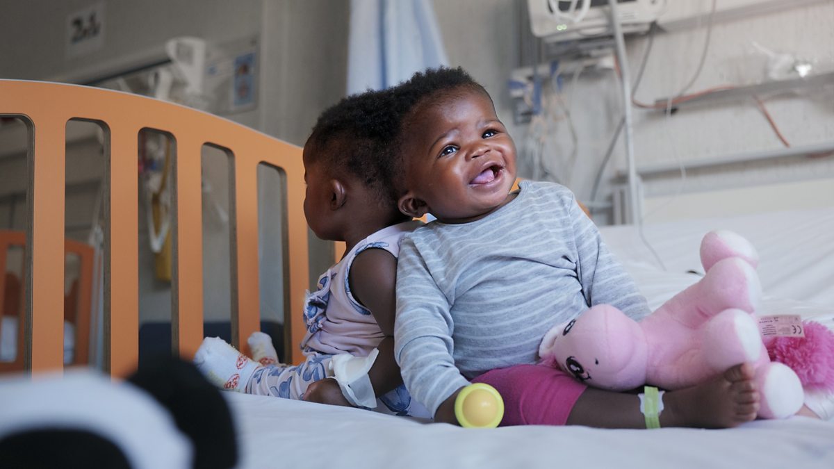 BBC World Service - Outlook, The battle to save two conjoined twins