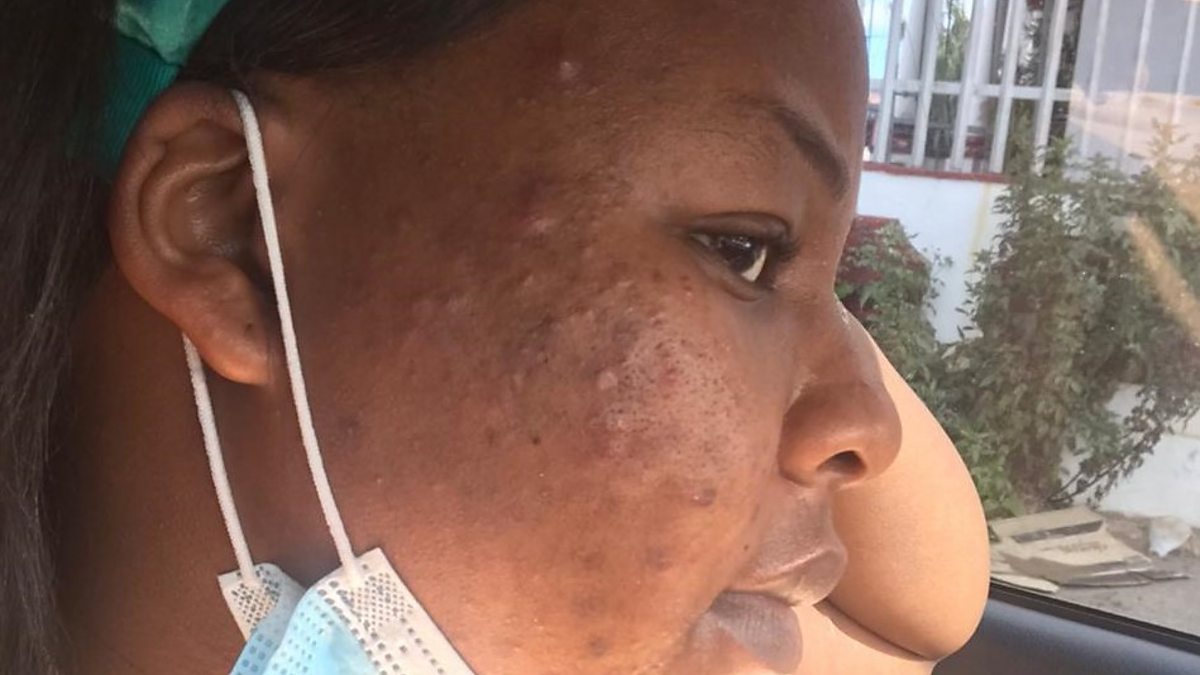 BBC World Service TV Life Clinic What Is Cystic Acne BBC World Service TV Life Clinic What Is Cystic Acne