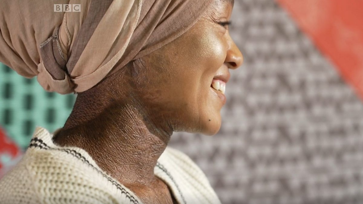 BBC World Service TV - Life Clinic, Lamellar ichthyosis: Zoey Seboe was ...