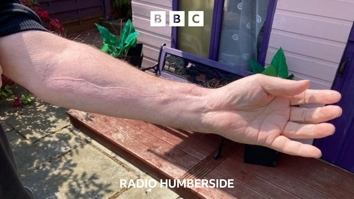 BBC Radio Humberside - BBC Radio Humberside, NHS 75: Hull Man "hospital ...