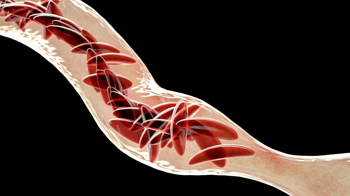 BBC World Service - Health Check, Sickle cell disease: Fighting for the ...