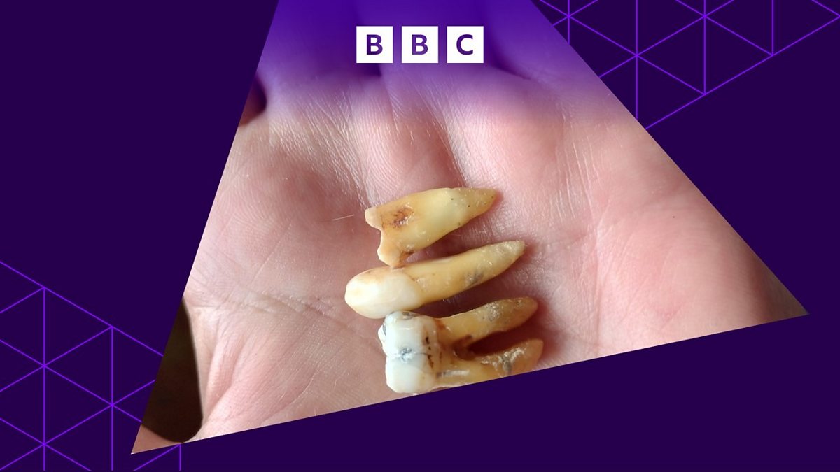 BBC Radio Devon - BBC Radio Devon, 'I had to pull my own teeth out'