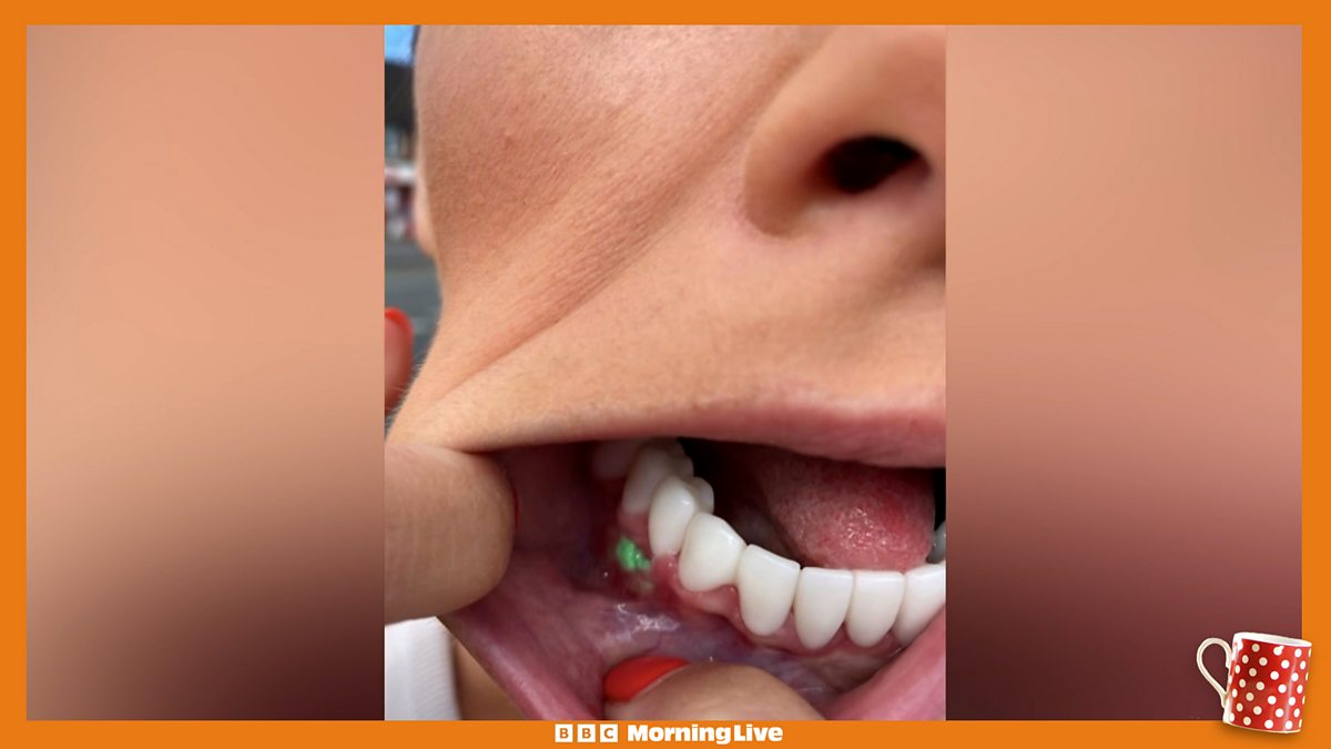 BBC One - Morning Live, What are the dangers of getting ‘Turkey teeth’?