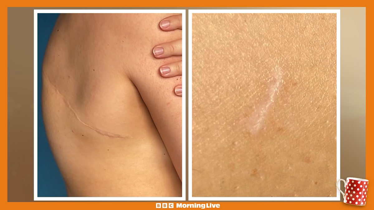 BBC One - Morning Live, How to manage and protect against scars