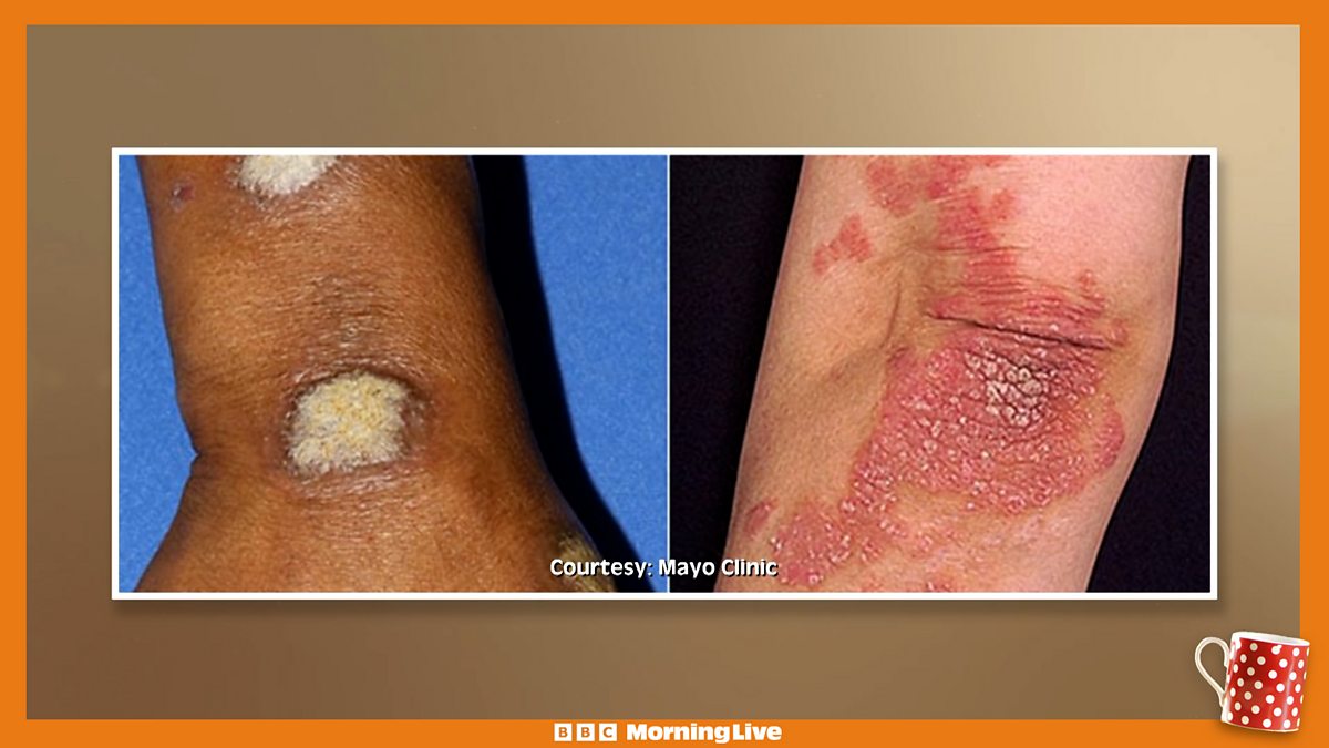 BBC One - Morning Live, How to help soothe skin conditions