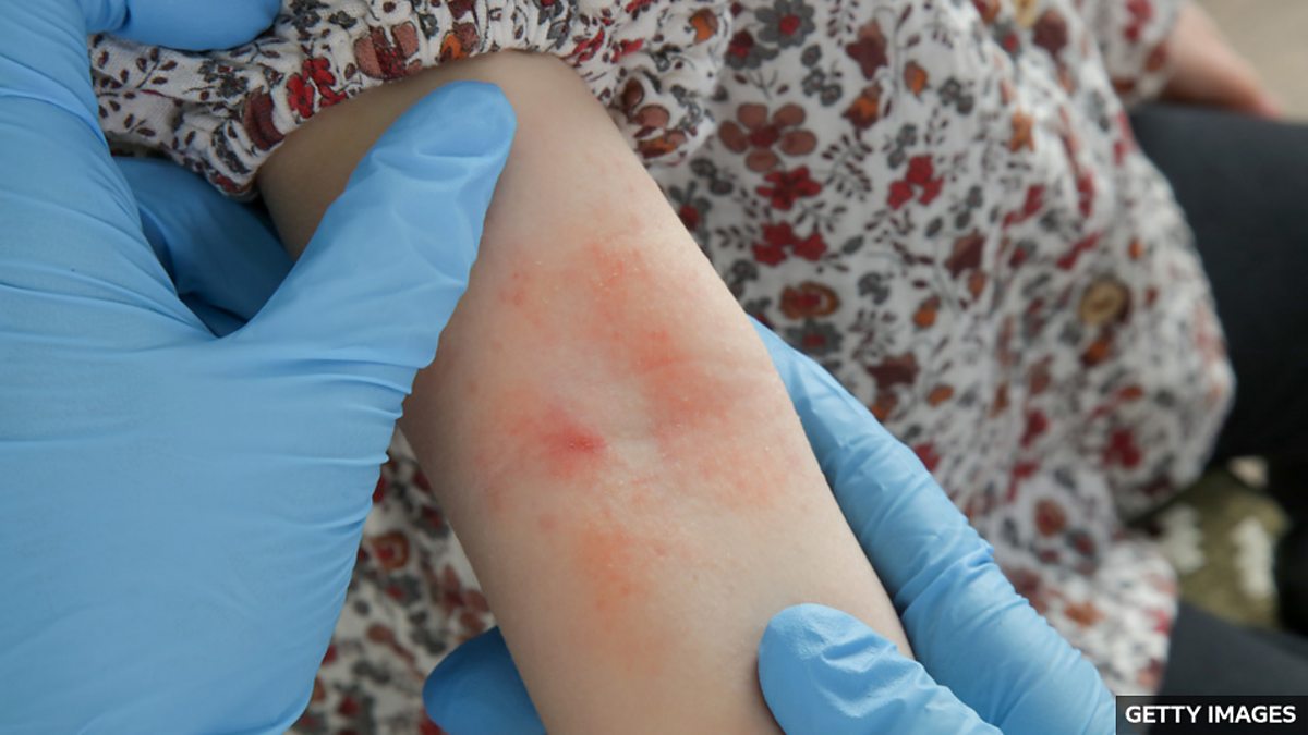 BBC Learning English - 媒体英语 / Baby sticky tape skin test can predict ...