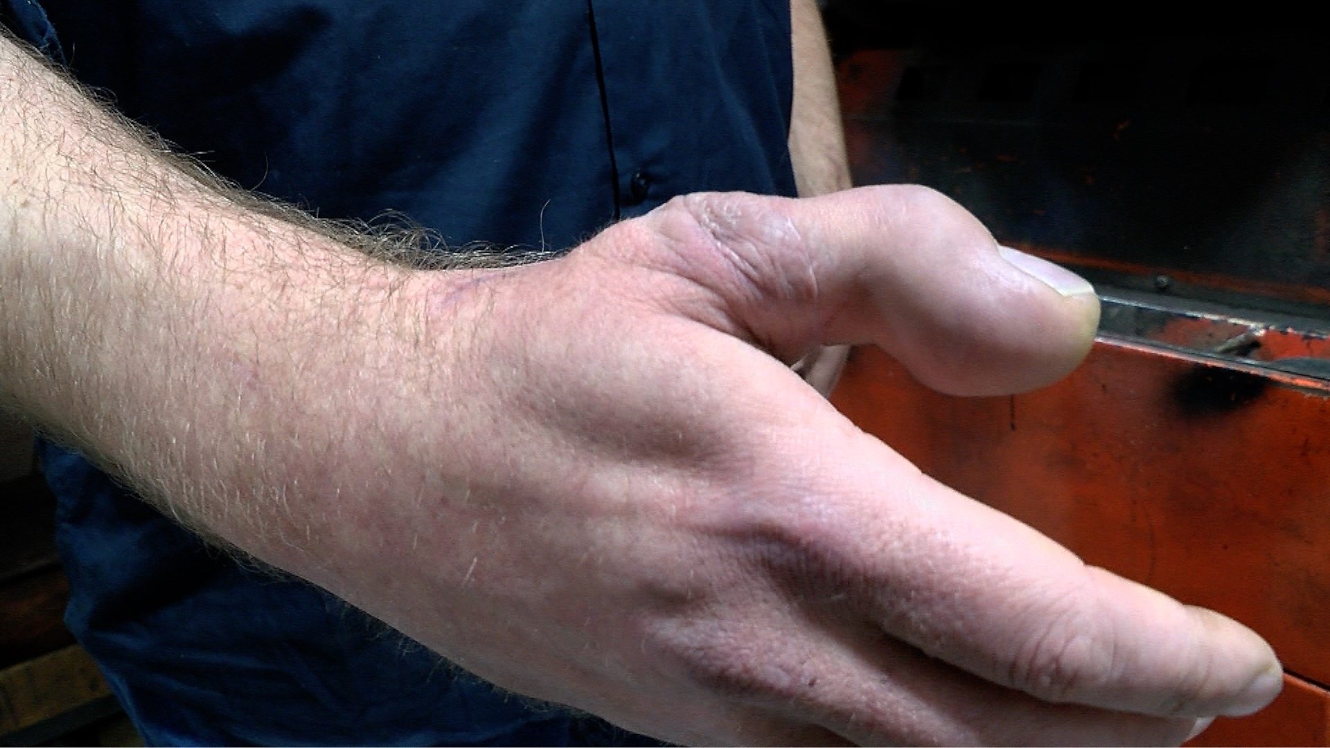 big toe thumb replacement