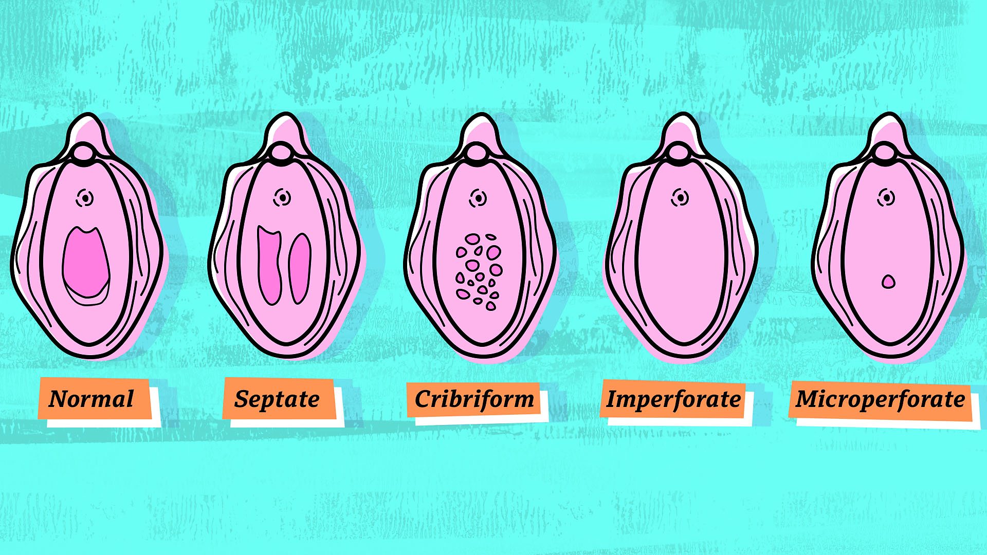 Hymen Abnormalities Using My First Tampon Put Me In A E BBC Three