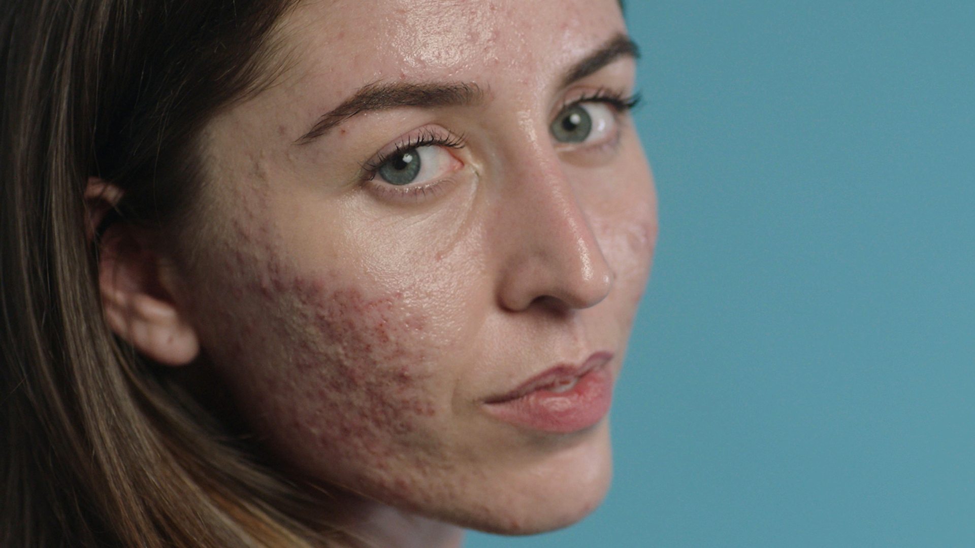 'My skin condition made me a hermit' - BBC Three