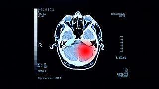 Brain injury - BBC News