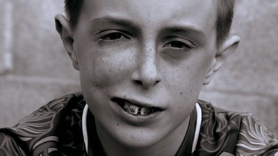 Facial disfigurement: The children bullied for how they look - BBC News