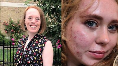 Campaign provides support for people with visible differences - BBC News