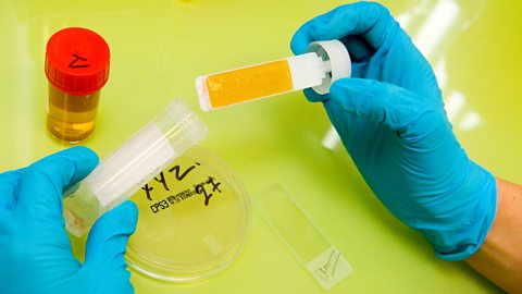 Why aren't there better treatments for cystitis?