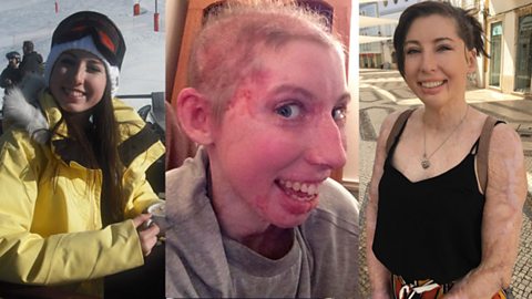 Burns survivor Catrin Pugh becomes physio for Katie Piper charity - BBC ...