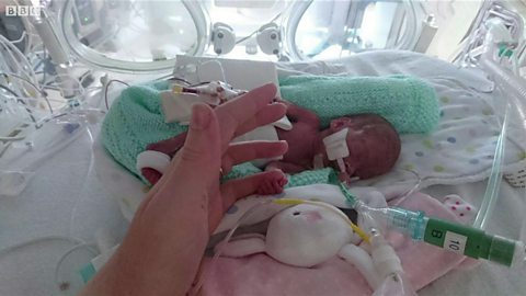 Baby born four months early survives surgery at Tooting hospital - BBC News