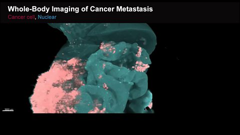 Spreading cancer caught on film - BBC News