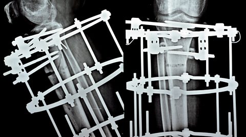 BBC Radio 4 - Life Changing - I faced leg amputation – or experimental ...