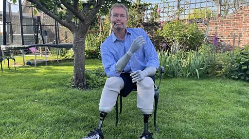 My limbs were amputated after sepsis, says MP Craig Mackinlay - BBC News