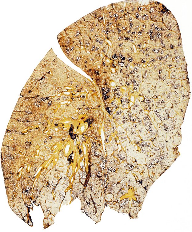 Smoking - BBC Bitesize