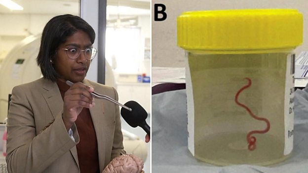 Live worm found in Australian woman's brain in world first - BBC News