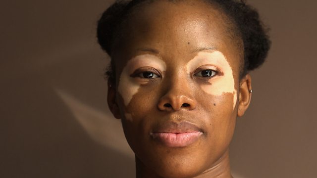 BBC - Preview, My Extraordinary Skin