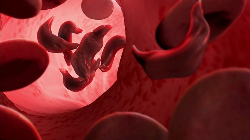 La drépanocytose en Afrique : les défis d'une meilleure prise en charge ...