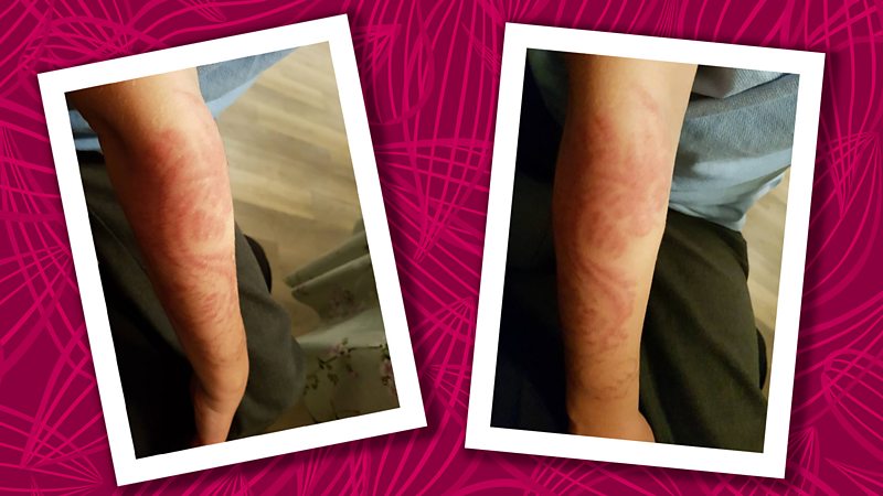 Black henna: 'My holiday henna tattoo scarred me for life' - BBC Three