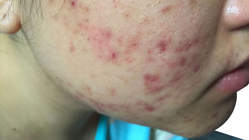 Can you cure acne with diet? - BBC Food