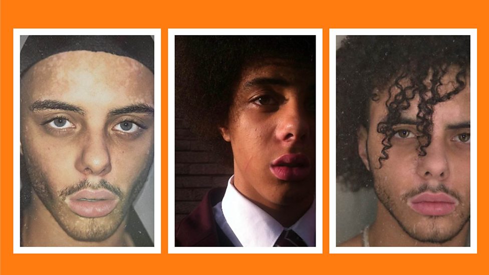 ‘If my vitiligo vanished, I’d be distraught’ - BBC Three