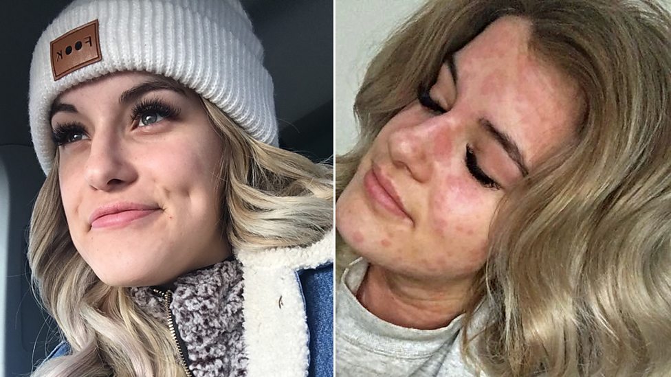 This woman has a rare allergy to cold winter weather - BBC Three