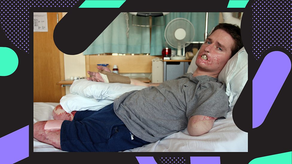 'I nearly died from toxic shock syndrome and never used a tampon' - BBC ...