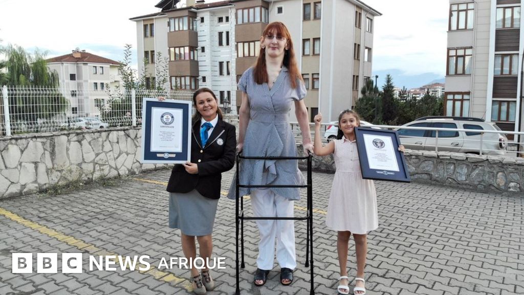 Syndrome de Weaver: c'est quoi cette maladie qui touche la femme la ...