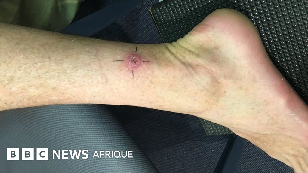 L'épidémie d'ulcère mangeur de chair en Australie est un mystère, selon ...